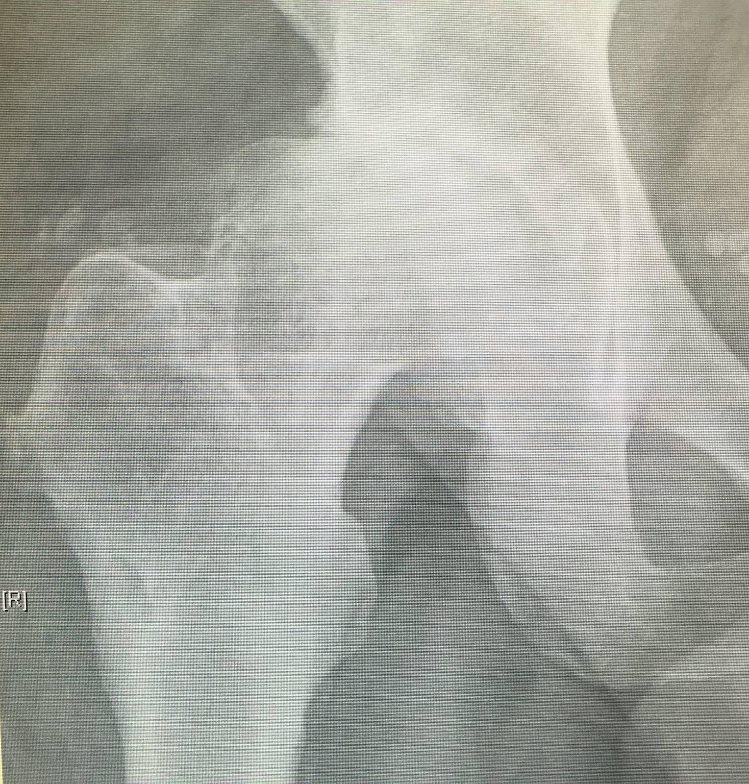 The one where I talk about Perthes Disease and me Pt1 – Bipolar Ironman